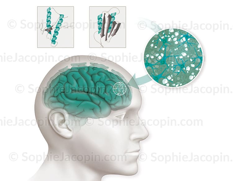 MALADIES À PRION - illustration-medicale.com - Sophie Jacopin