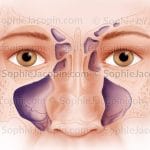 SINUSITE MAXILLAIRE - illustration-medicale.com - Sophie Jacopin